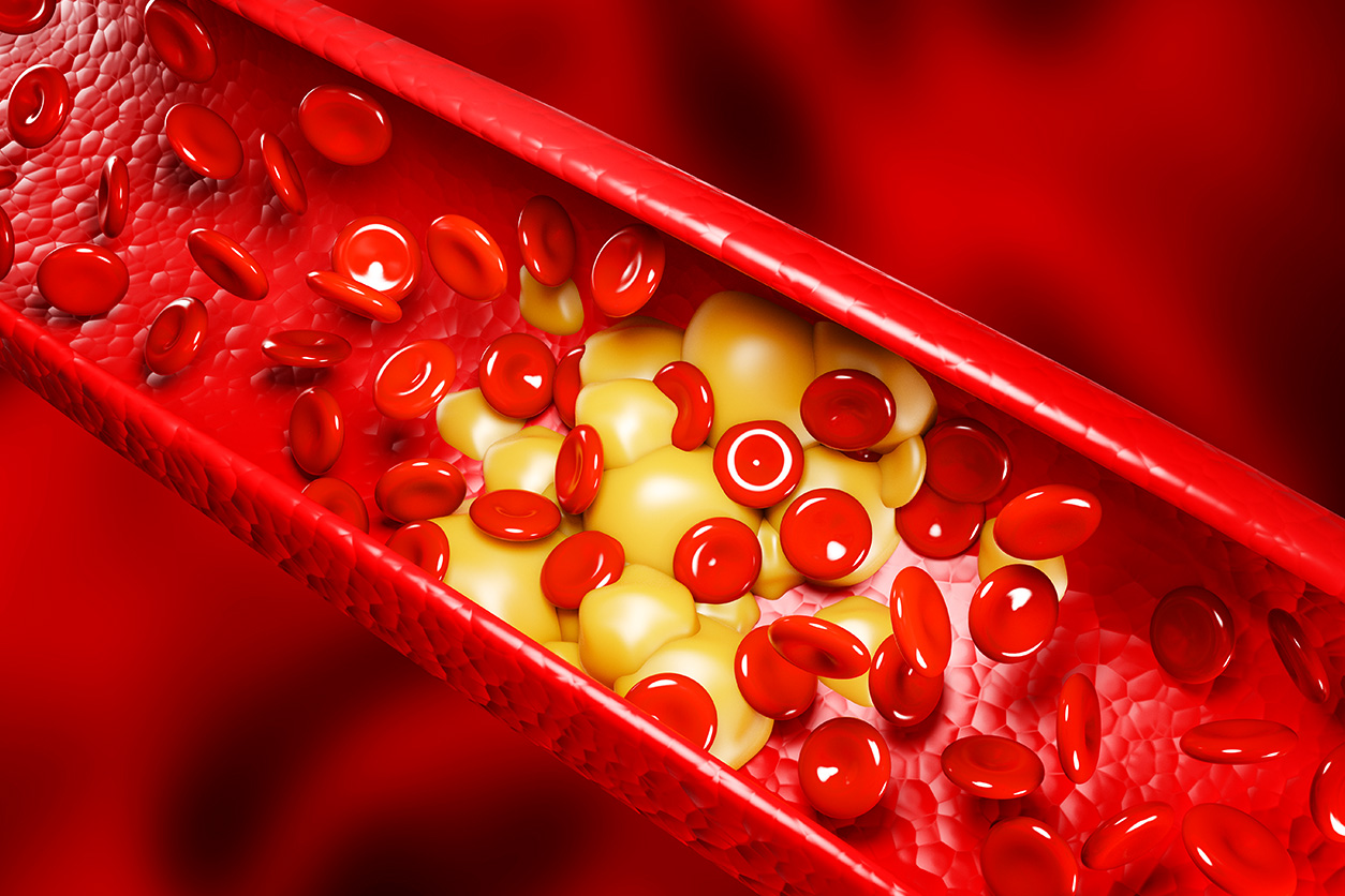 Dislipidemia: ¿Cómo afecta a tu salud y cómo prevenirla? - Bago